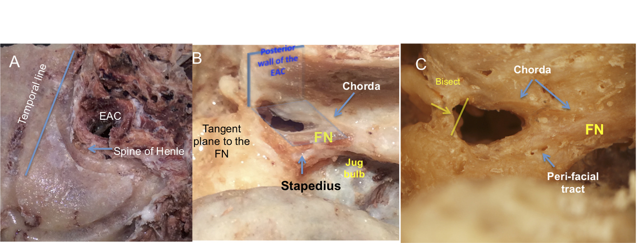 Temporal Bone Anatomy (Cadaveric Dissection) | Iowa Head and Neck Protocols - Carver College of ...